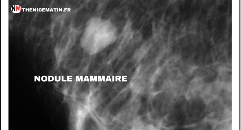 Le Nodule Mammaire : Comprendre, Diagnostiquer Et Traiter